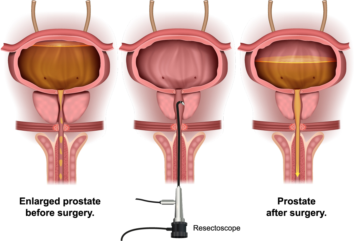 TURP Surgical Treatment For BPH TURP Surgical Treatment For BPH
